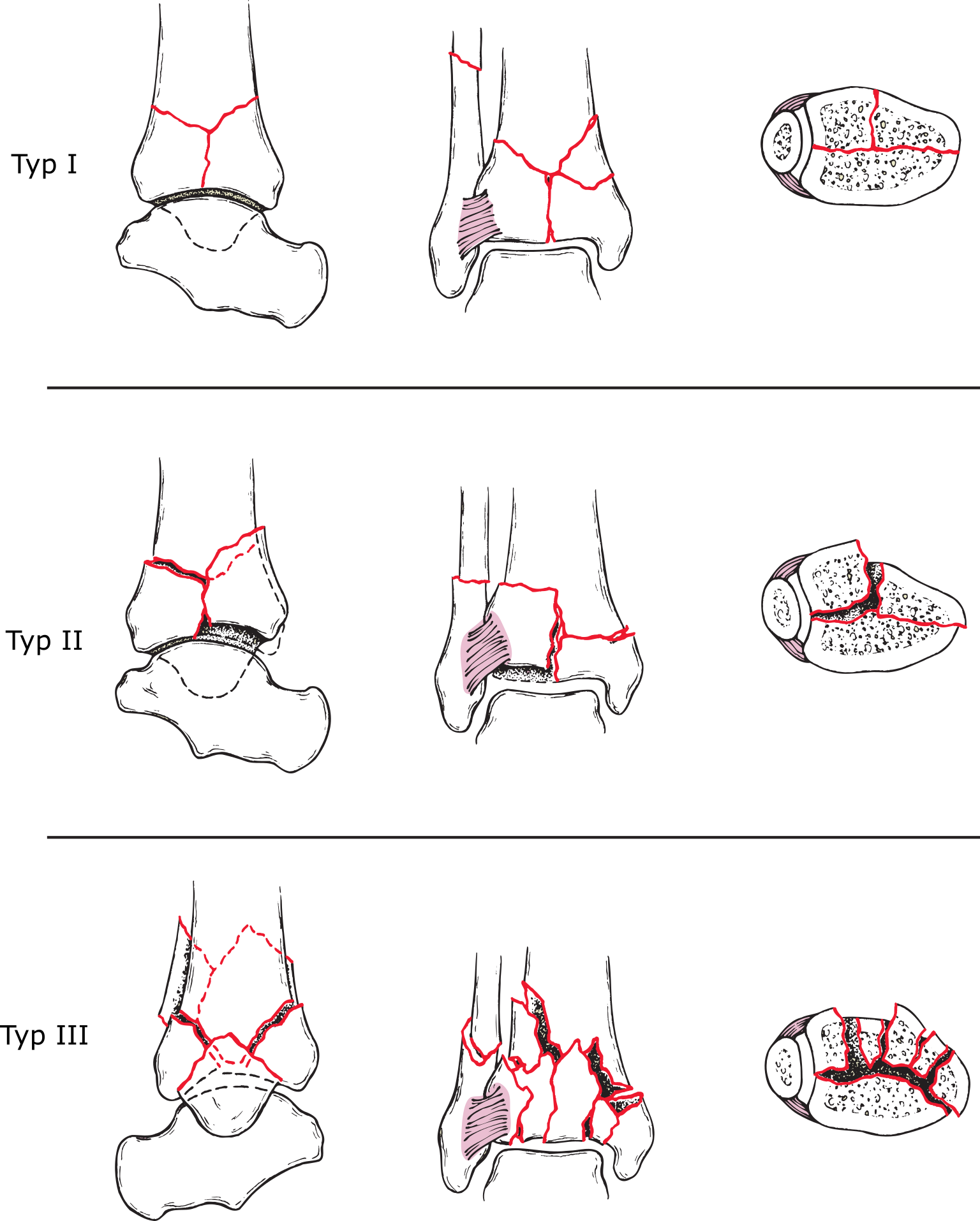 Tibiafraktur, Distal – Ortobas